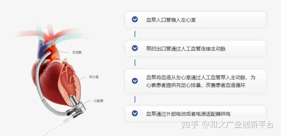 创新医疗器械盘点 | 心室辅助设备篇 - 知乎