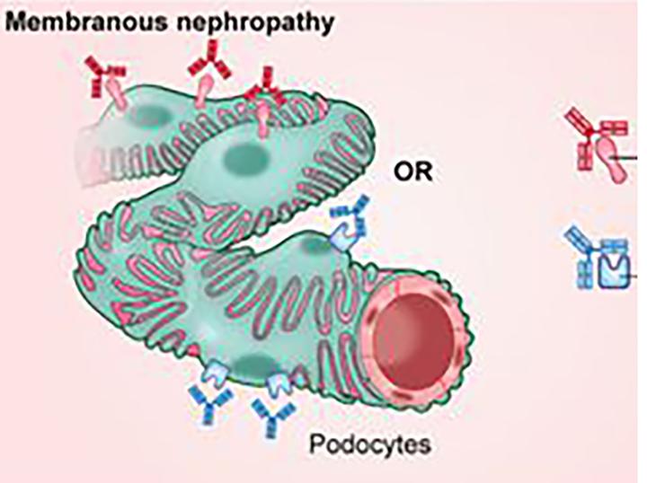 得了膜性肾病为什么医生那么强调PLA2-R？（上） - 知乎