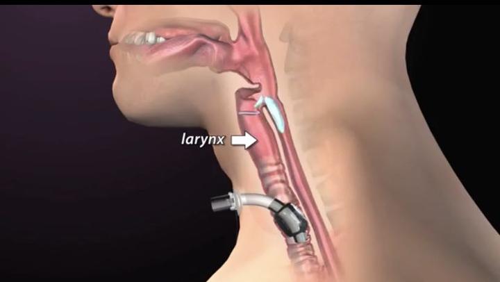 气管切开并发症的识别与处理，一文掌握（内附视频）第111期 - 知乎