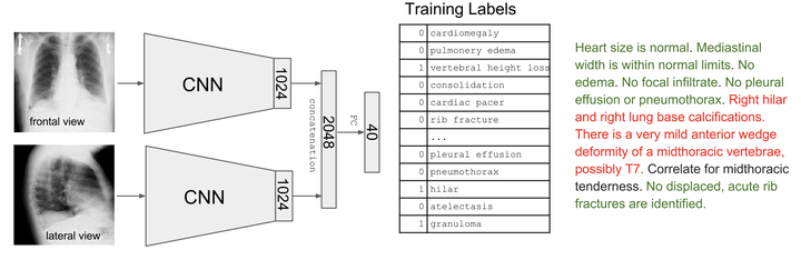 [论文笔记] TextRay: Mining Clinical Reports to Gain a Broad Understanding of Chest X-rays - 知乎