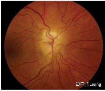 动脉炎性前部缺血性视神经病变 AAION - 知乎