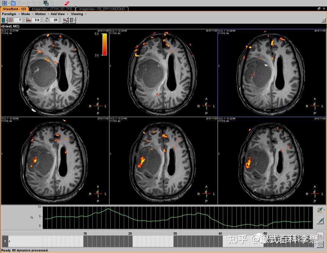 磁共振脑功能成像基础 - 知乎