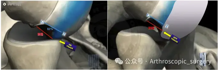 手术理念｜肩关节不稳中“on-track”和“off-track”是什么意思？ - 知乎