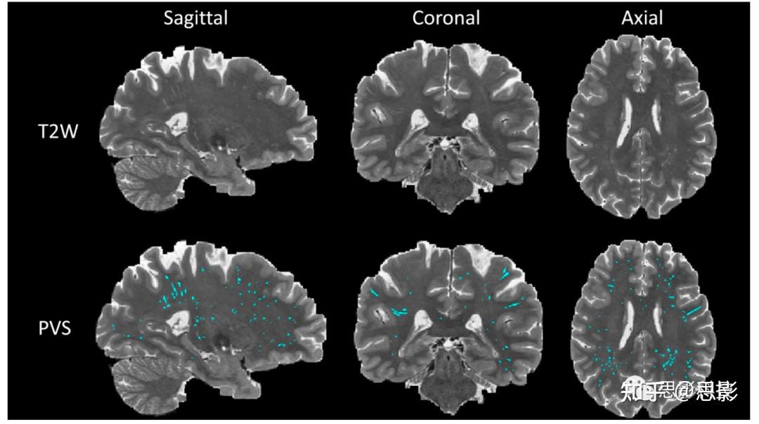 PVS：对血管周围间隙结构和功能的成像 - 知乎
