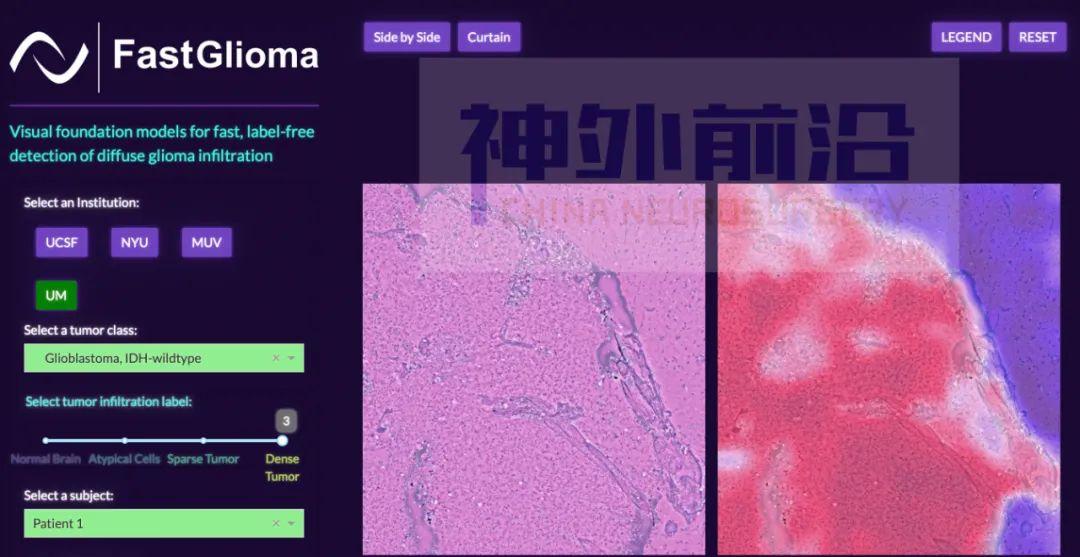 学术动态 | Nature报道结合显微光学成像的FastGlioma模型可在10秒内识别术中脑胶质瘤残余 准确率高达92% - 知乎