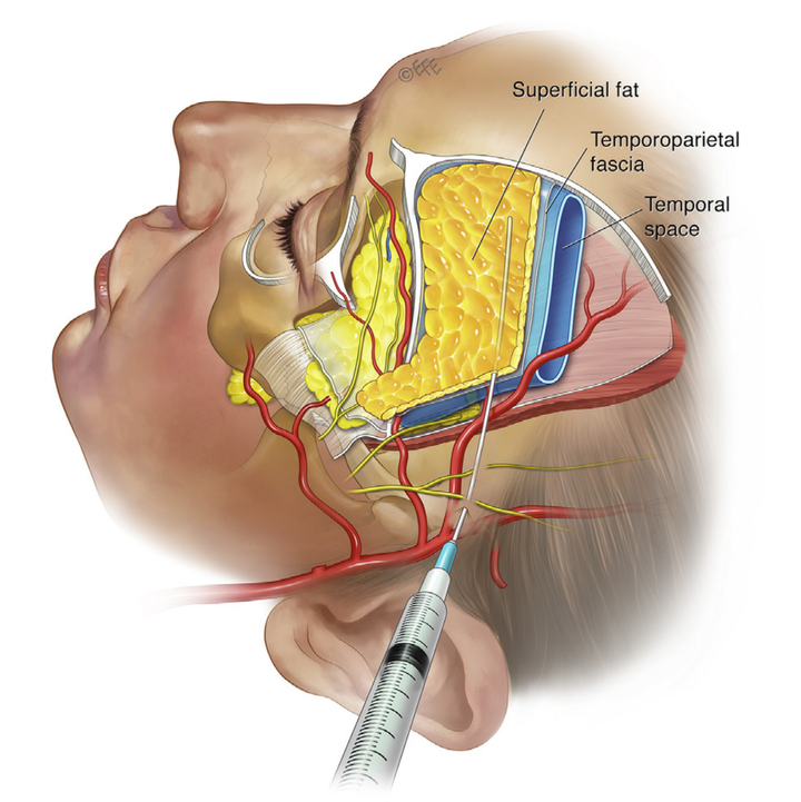 基于SMAS韧带的注射指导，即所谓的“True Lift”注射技术 - 知乎