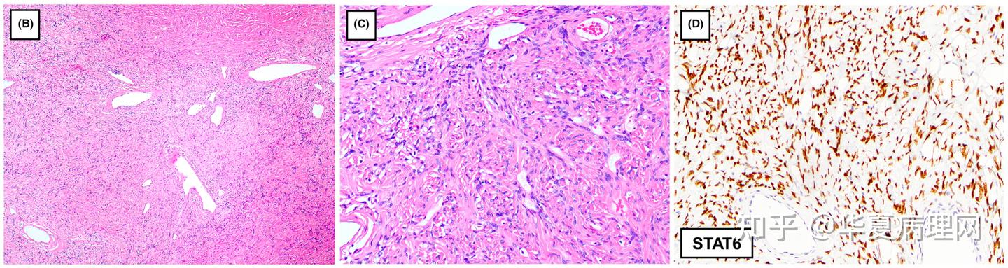 胸膜间叶性肿瘤概述（二） - 知乎
