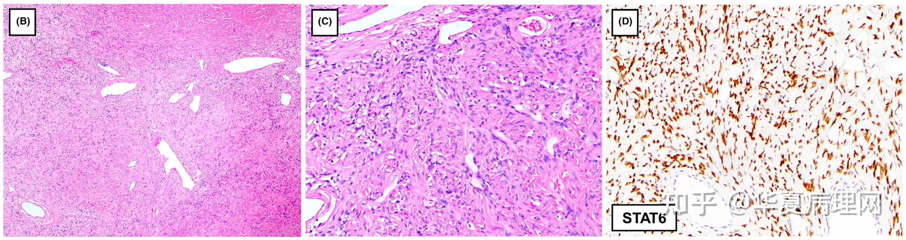 胸膜间叶性肿瘤概述（二） - 知乎