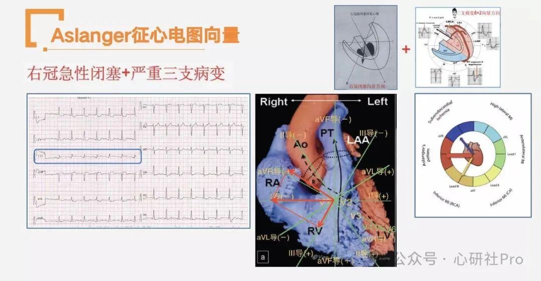 心电图的空间密码：从电向量到动态对比的临床解码 - 知乎