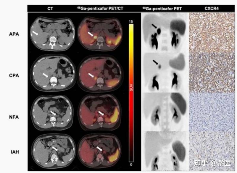 [68Ga]Ga-PentixaFor在肾上腺相关疾病的应用只是冰山一角...... - 知乎