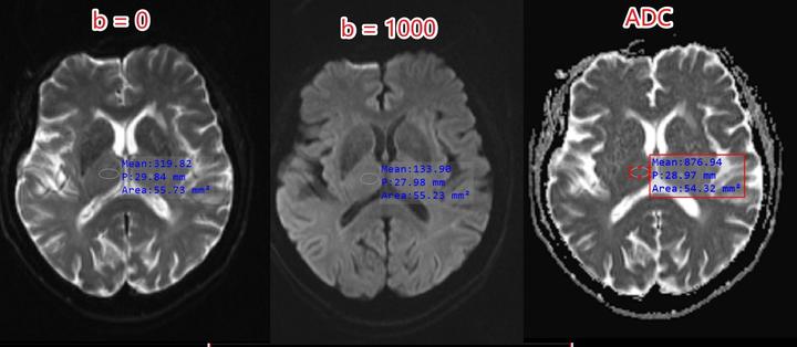 MRI ADC值是怎么来的？咱们来手算一下 - 知乎