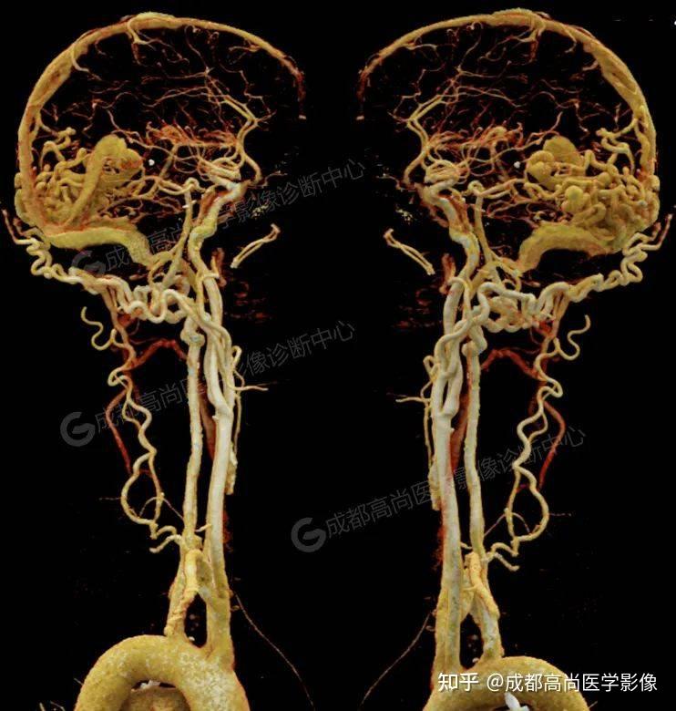 【高尚病例】头颅CTA发现脑动静脉畸形1例【成都高尚医学】 - 知乎
