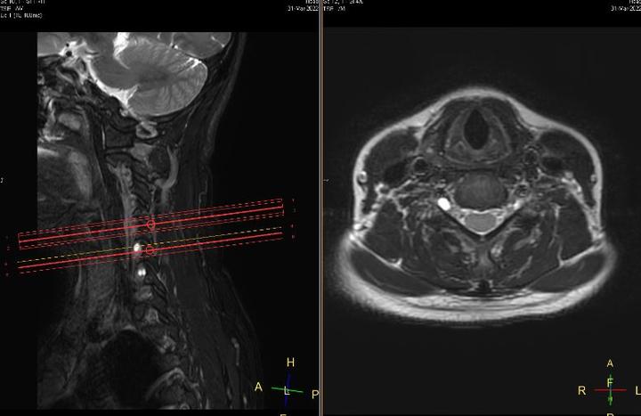 脊柱MRI扫描常见病变——神经根袖囊肿 - 知乎