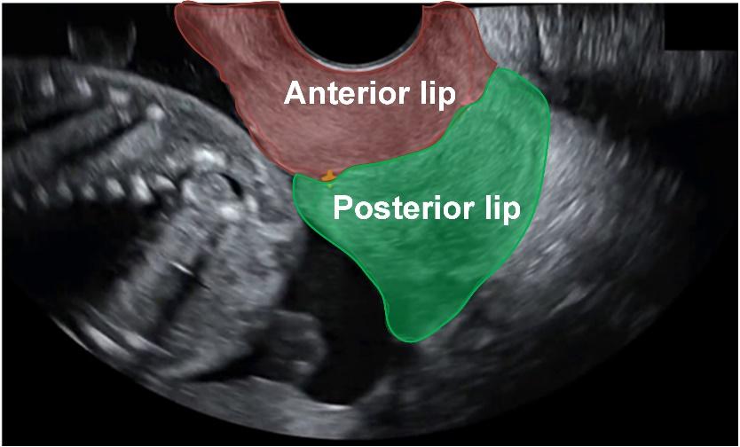 ISBI 2025 FUGC 宫颈超声图像分割挑战赛及数据集介绍 - 知乎