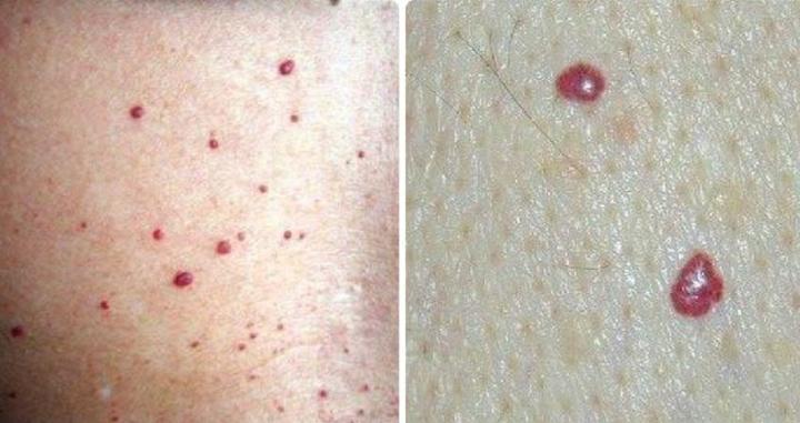 身上长红色的痣，说明肝脏有问题吗？ - 知乎