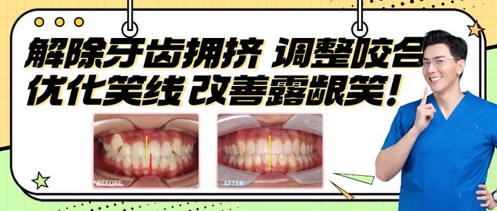 入选Invisalign Global Gallery | 青少年不拔牙矫正，解除牙齿拥挤、改善露龈笑！ - 知乎