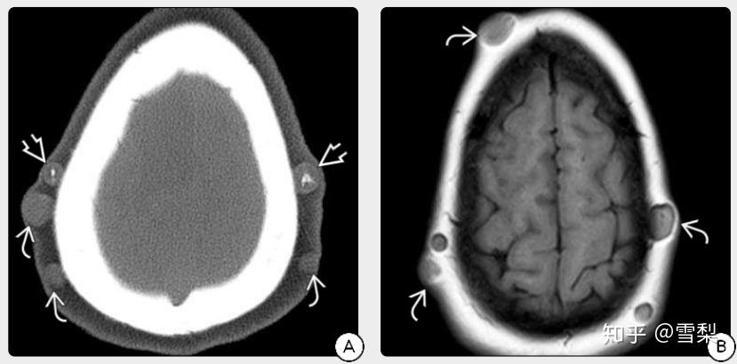 Scalp Cysts 头皮囊肿: trichilemmal cysts毛鞘囊肿 - 知乎