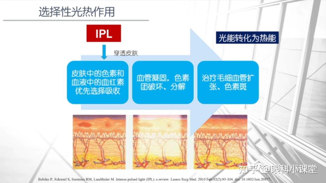 干眼系列课程 | 晏晓明教授《IPL治疗MGD的机制研究》 - 知乎