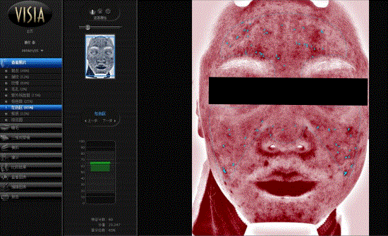 VISIA红是为啥红？ - 知乎