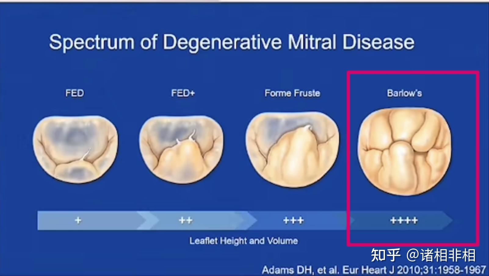 barlow综合征和一般的二尖瓣脱垂有什么区别？ - 知乎