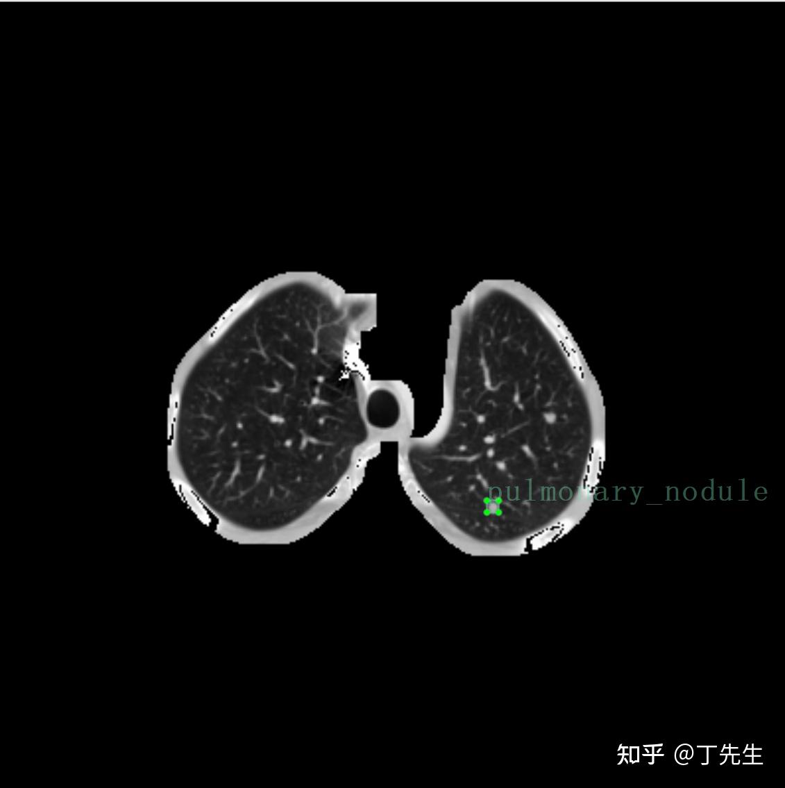 LUNA16肺结节数据集 - 知乎