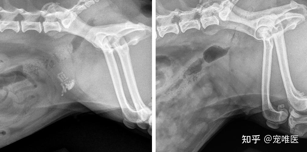 Non-Surgical Treatment for Bladder Stones: Cystoscopic Laser ...