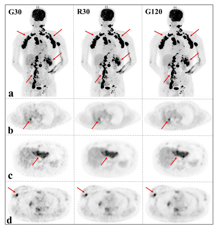 协同创新｜影动医疗 RaDynPET重建增强技术在欧核（EJNMMI）发表 - 知乎