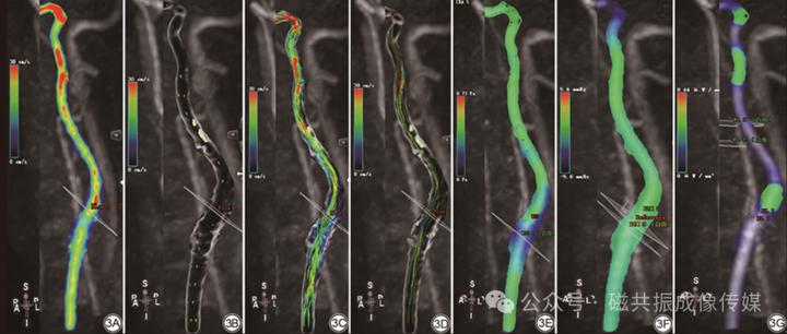 4D Flow MRI评估颈动脉狭窄及卒中相关血流动力学危险因素的研究 - 知乎