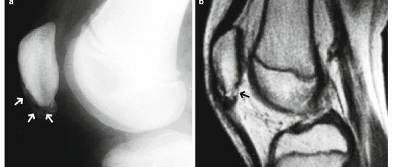 辛丁-拉森-约翰逊病（Sinding-Larsen-Johansson Disease）磁共振诊断 - 知乎