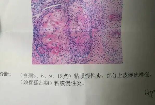 宫颈活检有疣样改变是什么意思 知乎