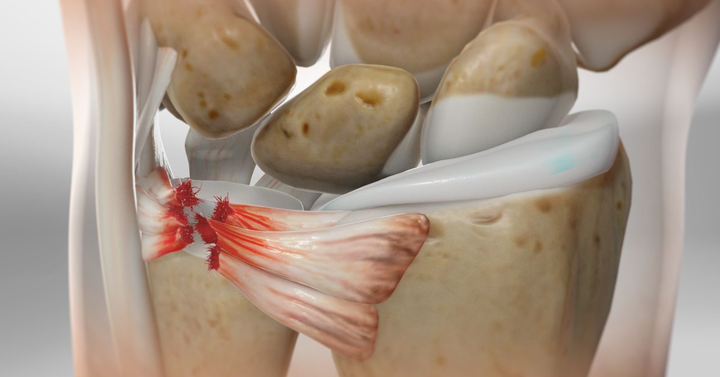 腕关节疼痛的“元凶”：TFCC损伤与康复全攻略 - 知乎