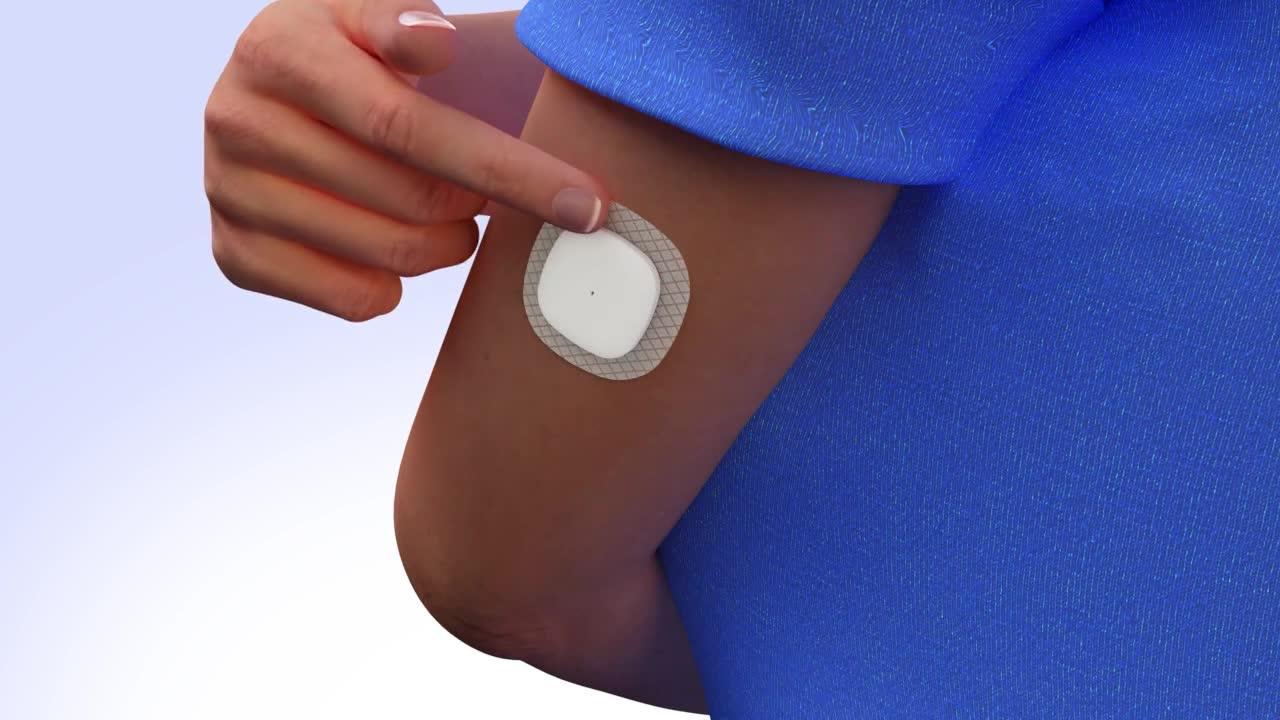 【CE认证】美敦力全抛型Simplera CGM集成Minimed 780G人工胰腺获批 - 知乎