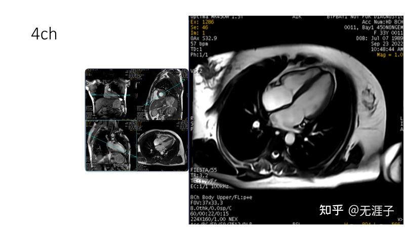 Cardiac base position - 知乎