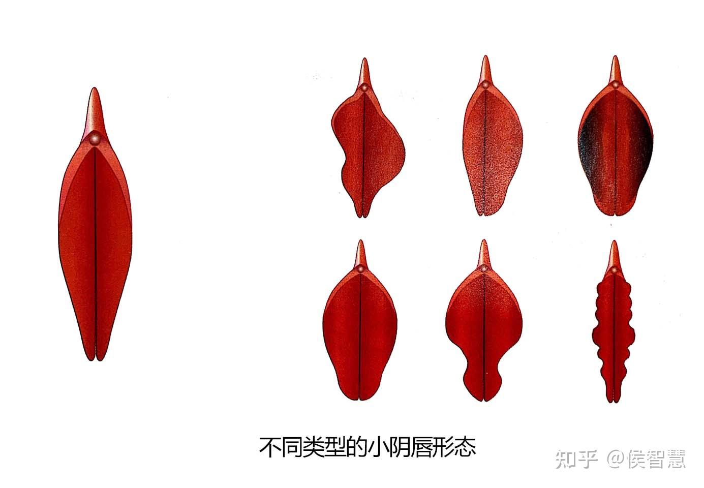 【小阴唇全解】（二）什么样的小阴唇形态是不美观的？ 知乎