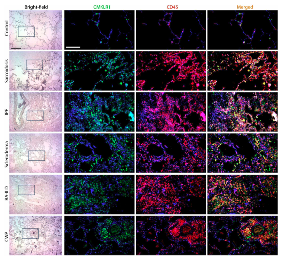 Science Advanes丨通过CMKLR1靶向成像对肺部炎症-纤维化轴进行非侵入性评估 - 知乎