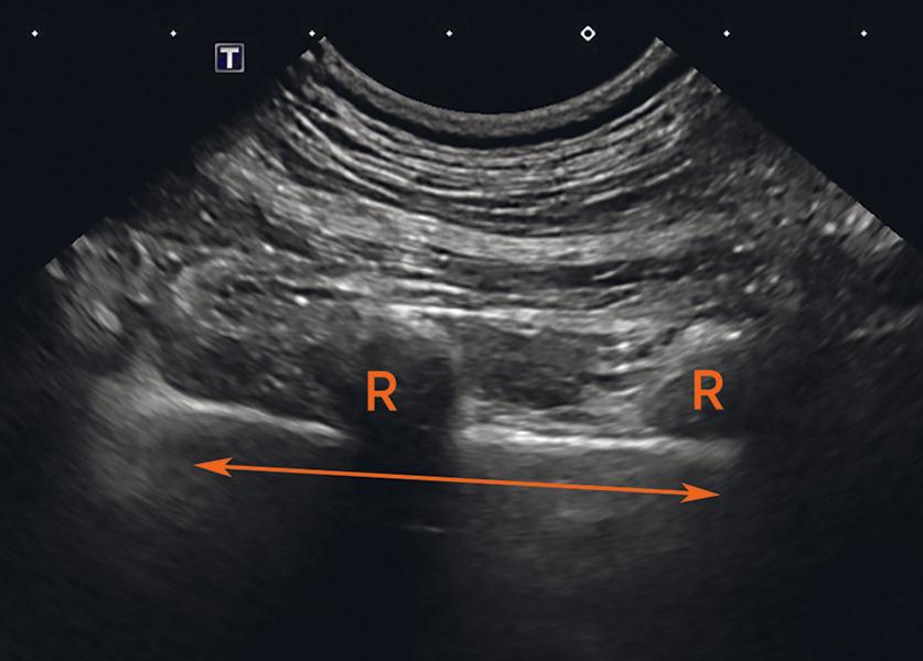超声评估：AFAST和TFAST概述 - 知乎