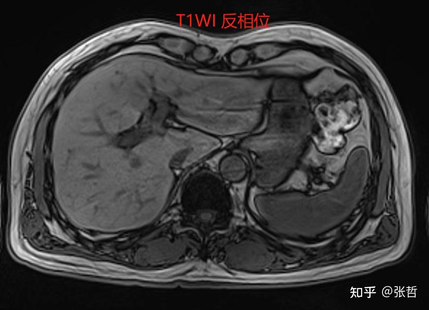 T1WI T2WI PdWI 区别？ - 知乎