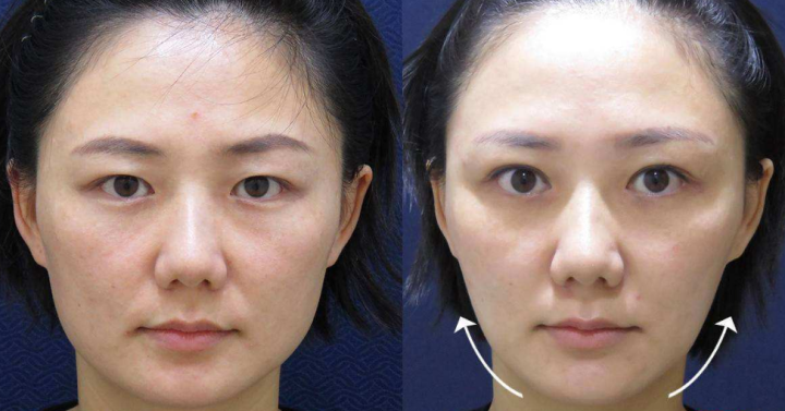 线雕的线PDO、PPDO、PLLA有啥区别？为什么这么多人想做线雕提升？ - 知乎