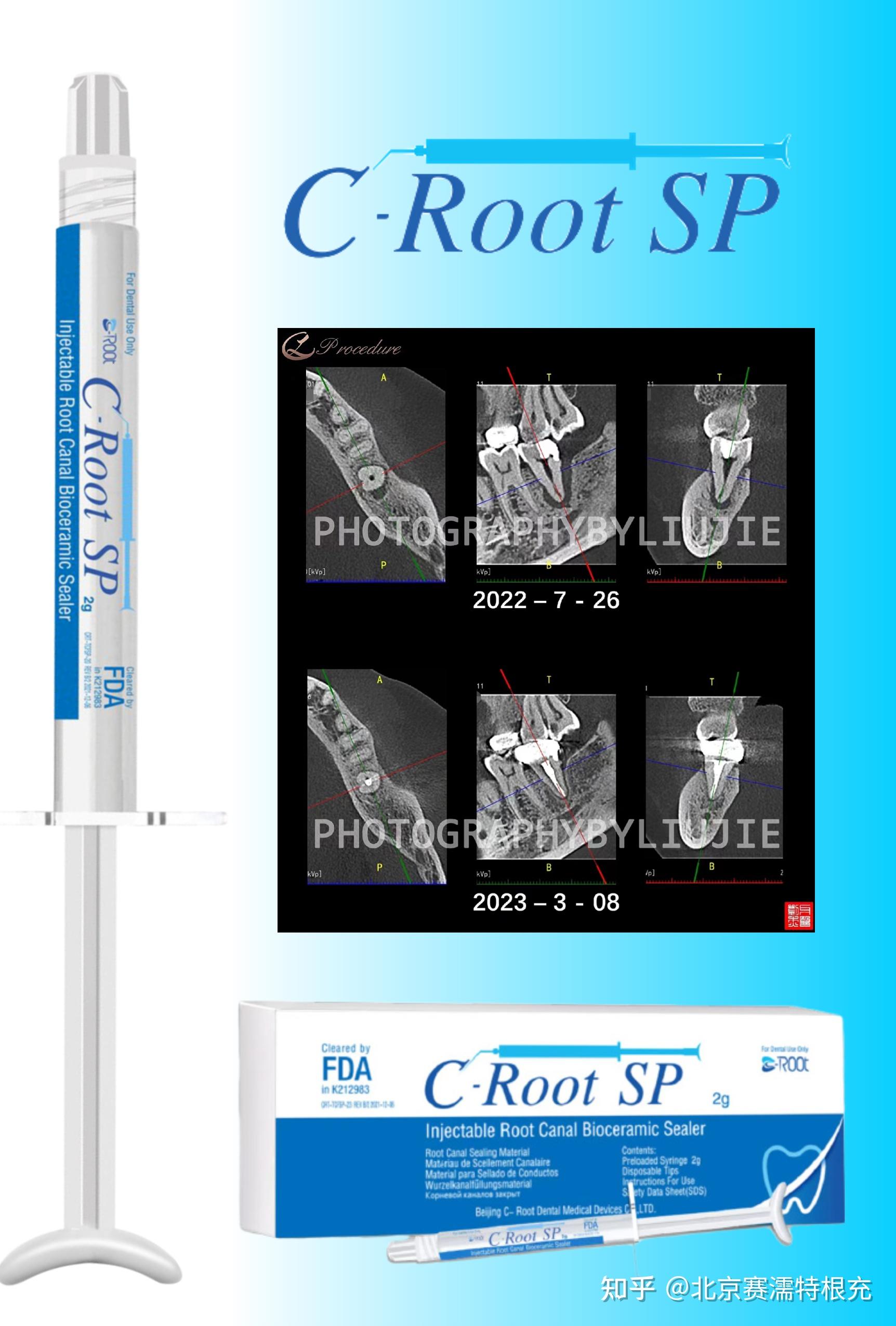 直击AAE展 | 当赛濡特C-Root SP与国外牙科医生见面时！ - 知乎