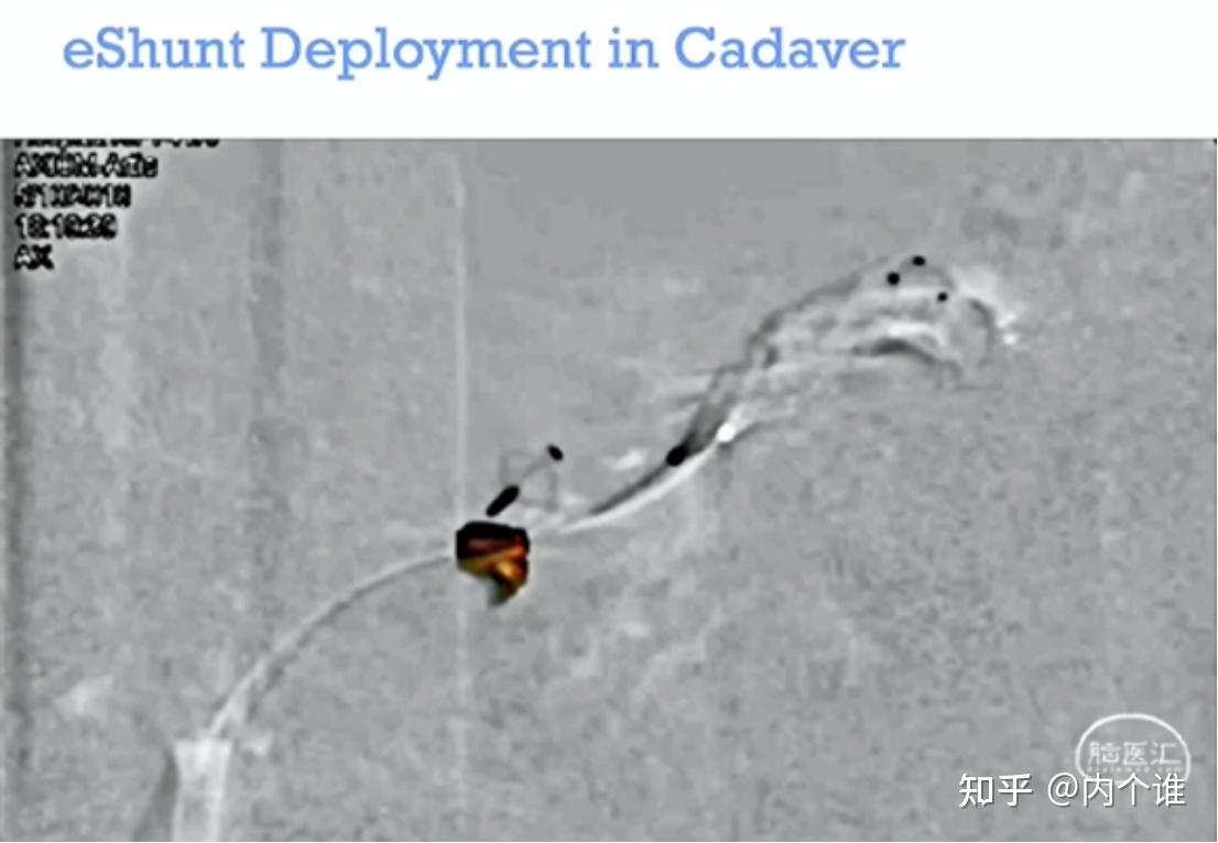 【行业资讯】eShunt脑积水分流介入导管 - 知乎