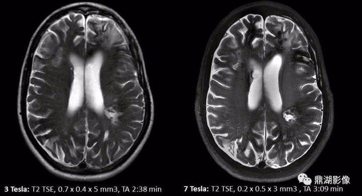 重大突破！临床磁共振进入7T时代！ - 知乎