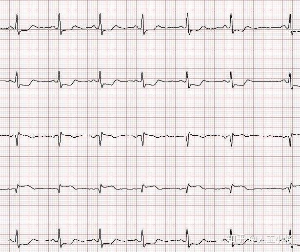 深度医疗(1) - 基于深度学习心电图(ECG)特征识别 - 知乎