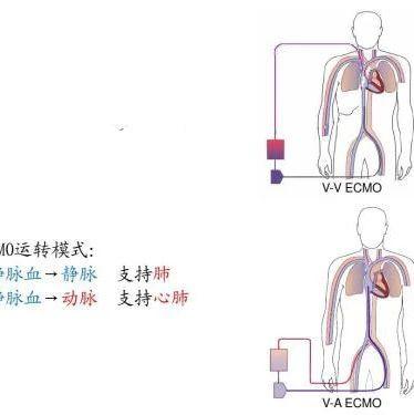 ECMO基础知识，最全总结！ - 知乎