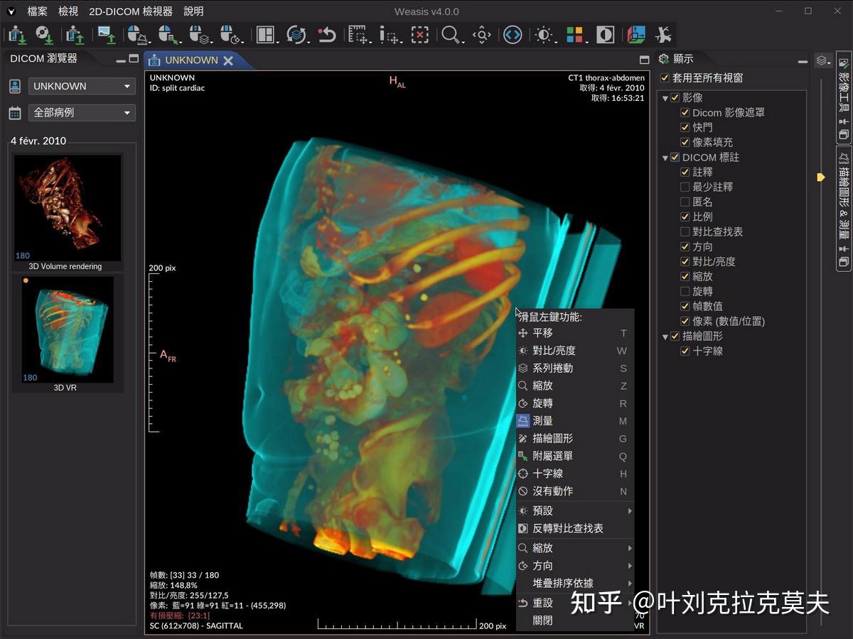 开源科学工程技术软件介绍16 – DICOM医学图片查看器Weasis - 知乎