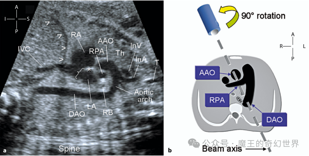胎儿心脏超声之主动脉弓切面、动脉导管弓切面 - 知乎