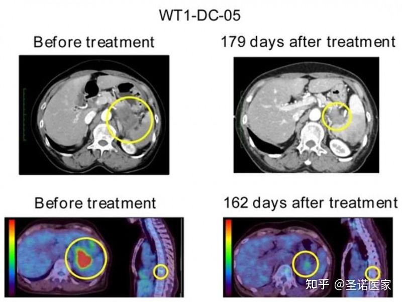 中美两国共846个癌症疫苗项目获批临床,生存期屡破3年大关!打一针阻断20多款癌种? - 知乎