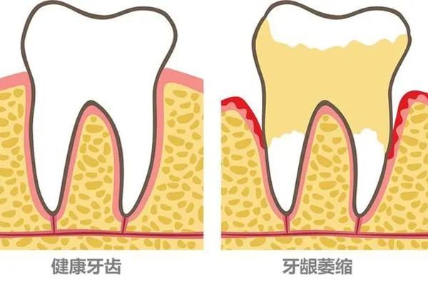 中年人牙龈萎缩怎么恢复?不同原因导致的萎缩恢复方式不同 知乎