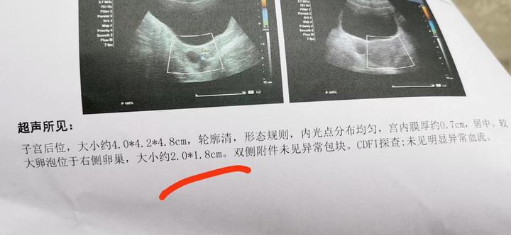 卵巢早衰amh124卵泡长不大，调理中复查监测到2018的优势成熟卵泡！ 知乎