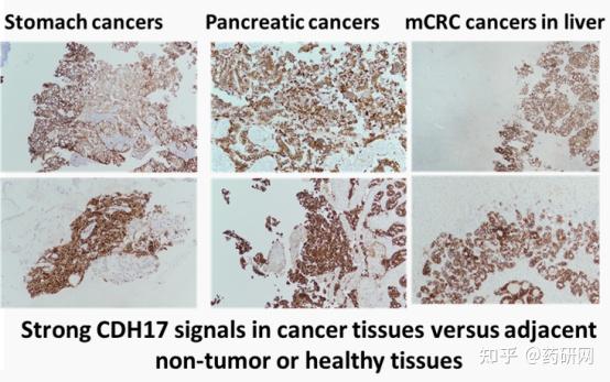 实体瘤靶点新秀：CDH17 - 知乎