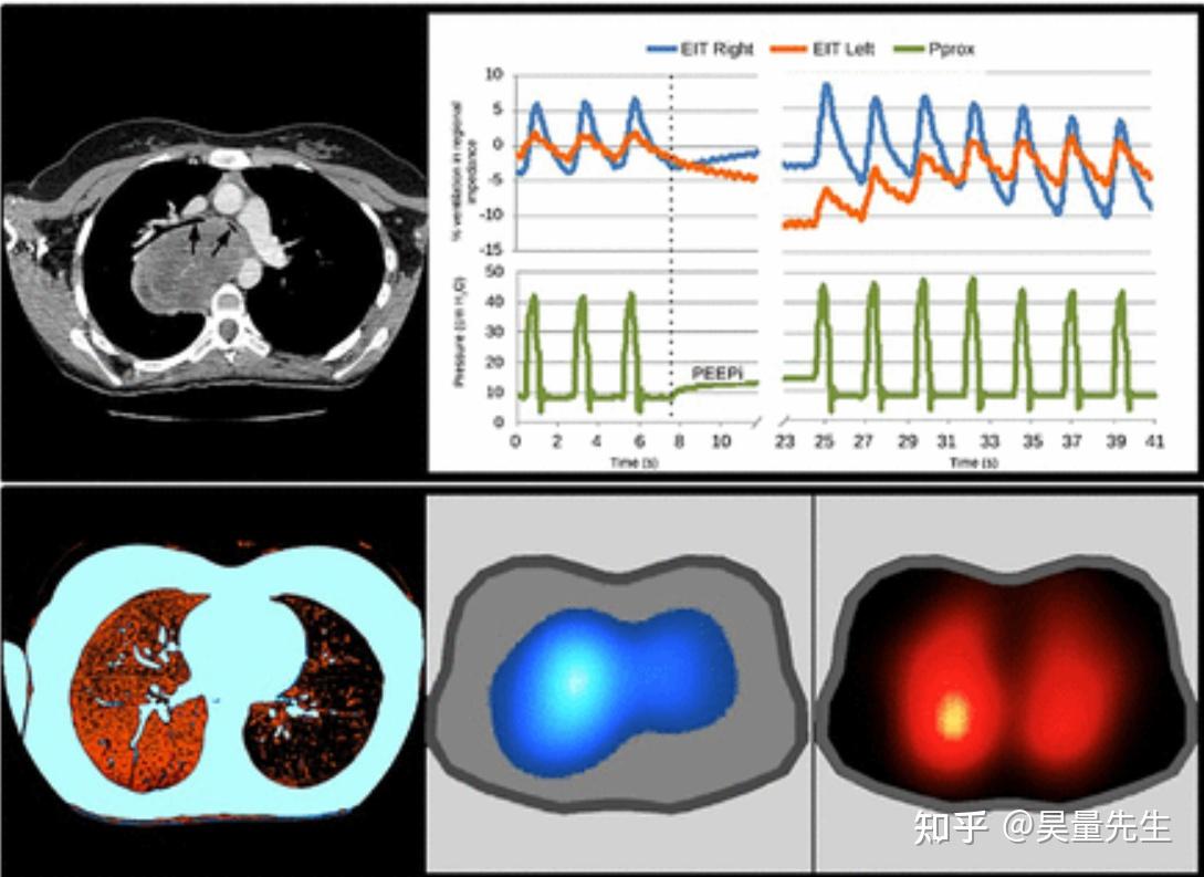 胸阻抗断层成像仪临床前解决方案—Sciospec Lung EIT Kit - 知乎